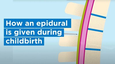 How an epidural is given during childbirth - BYU-Idaho