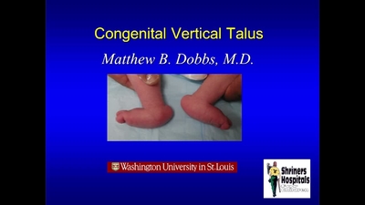 Congenital Vertical Talus - POSNAcademy