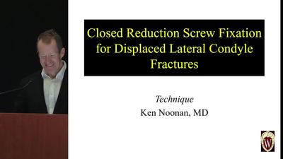 Closed Reduction Screw Fixation for Displaced Lateral Condyle Fractures ...