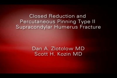 Percutaneous Pinning Not All Proximal Humerus Fractures Amenable To