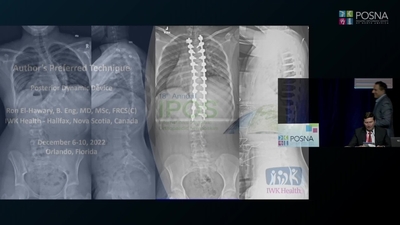 IPOS® 2022: Posterior Dynamic Deformity Correction Device - POSNAcademy