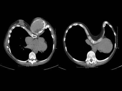 Modified Ravitch Procedure for Pectus Excavatum - ConsultQD Live ...