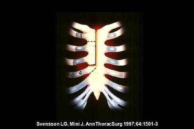 Minimal J Incision Aortic Valve Replacement with Trifecta Valve ...